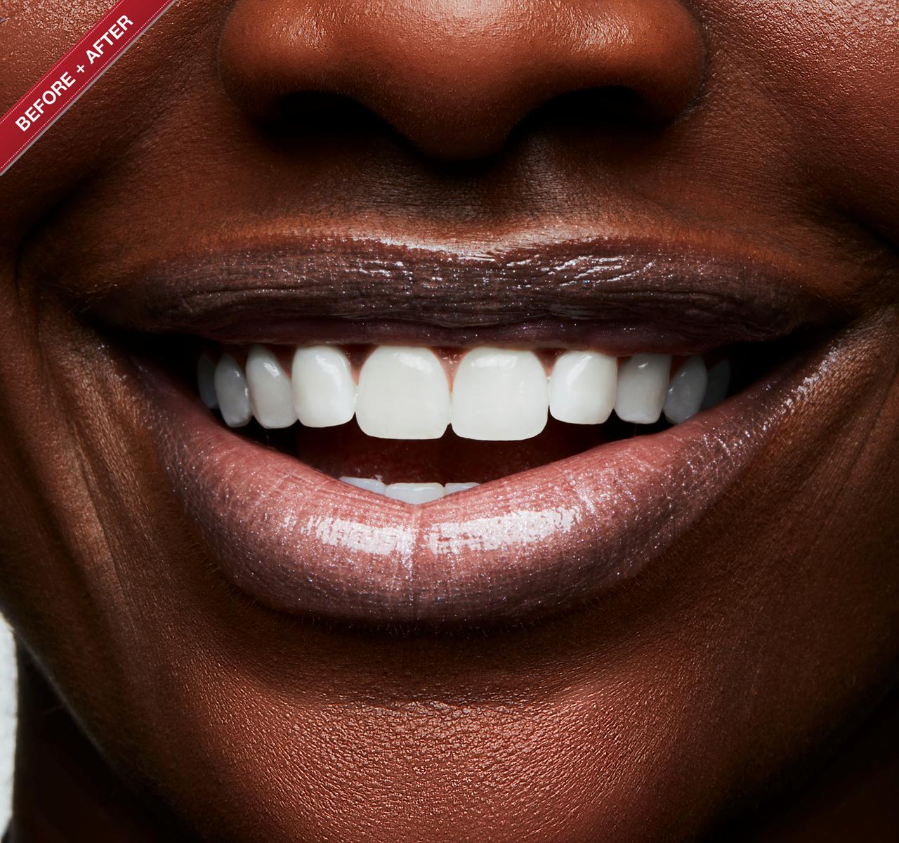 Photo Lip & Teeth edited by marlon o. - Phowd